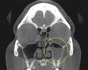 In-Office Treatment of Chronic Sinusitis | GNO Snoring & Sinus
